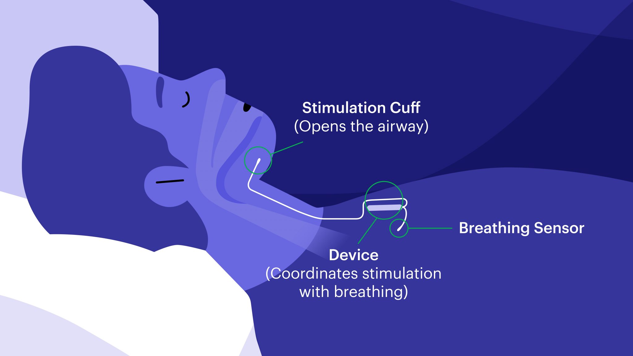A Revolutionary Device For Treating Sleep Apnea Is Headed For Ipo